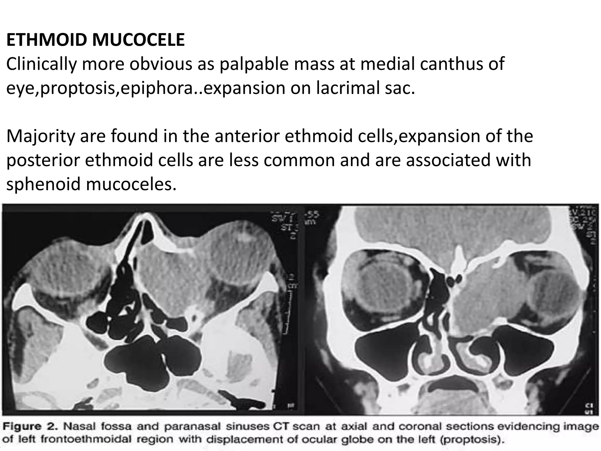 Sinonasal polyps | PPTX