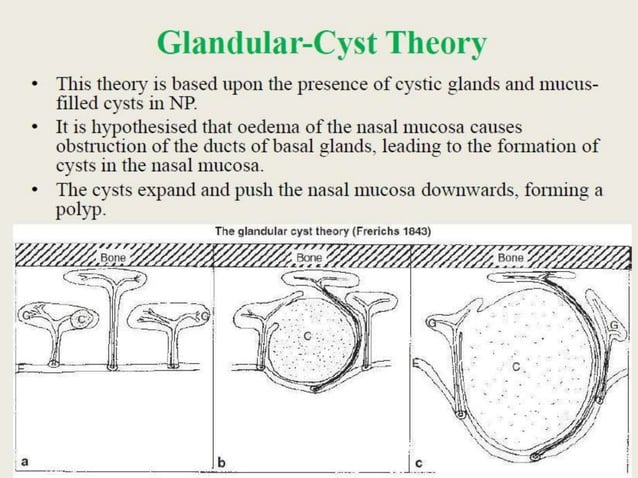 Sinonasal polyps | PPTX