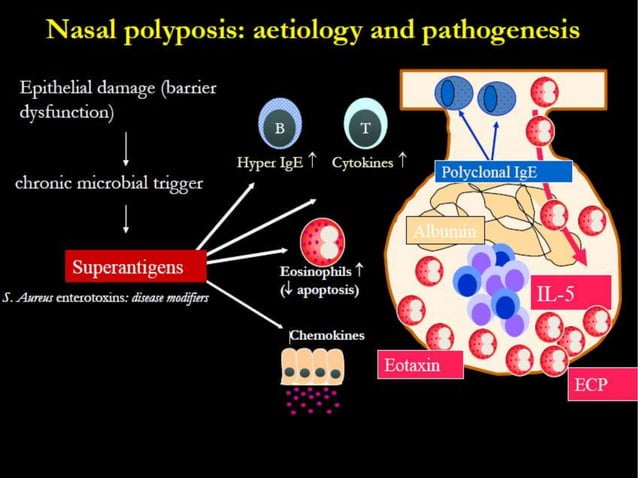 Sinonasal polyps | PPTX