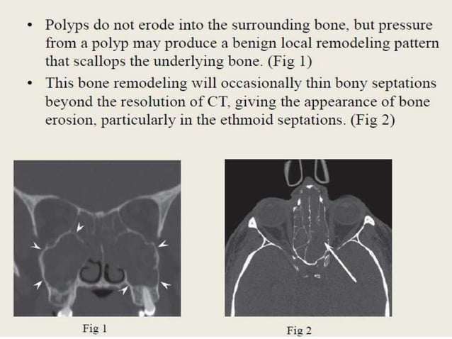 Sinonasal polyps | PPTX