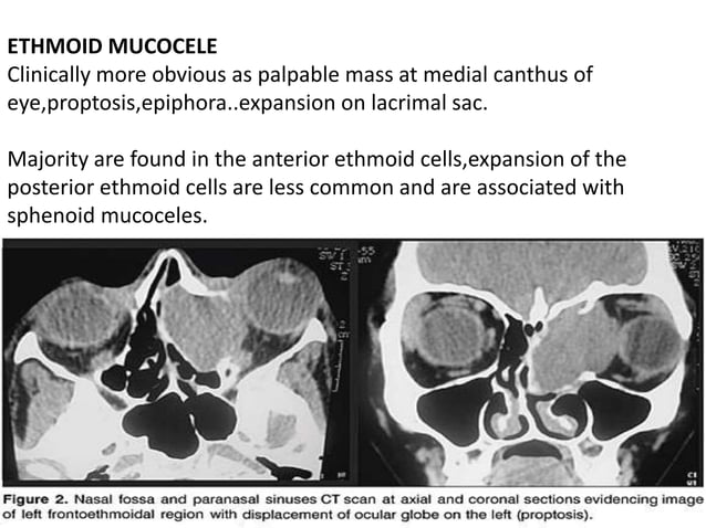 Sinonasal polyps | PPTX