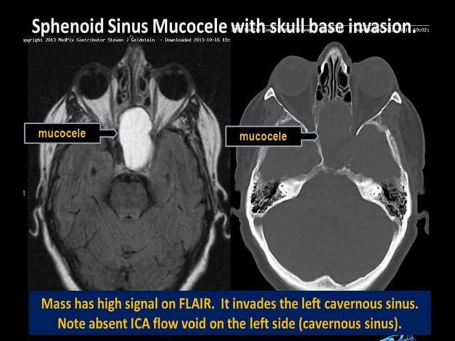 Sinonasal polyps | PPTX