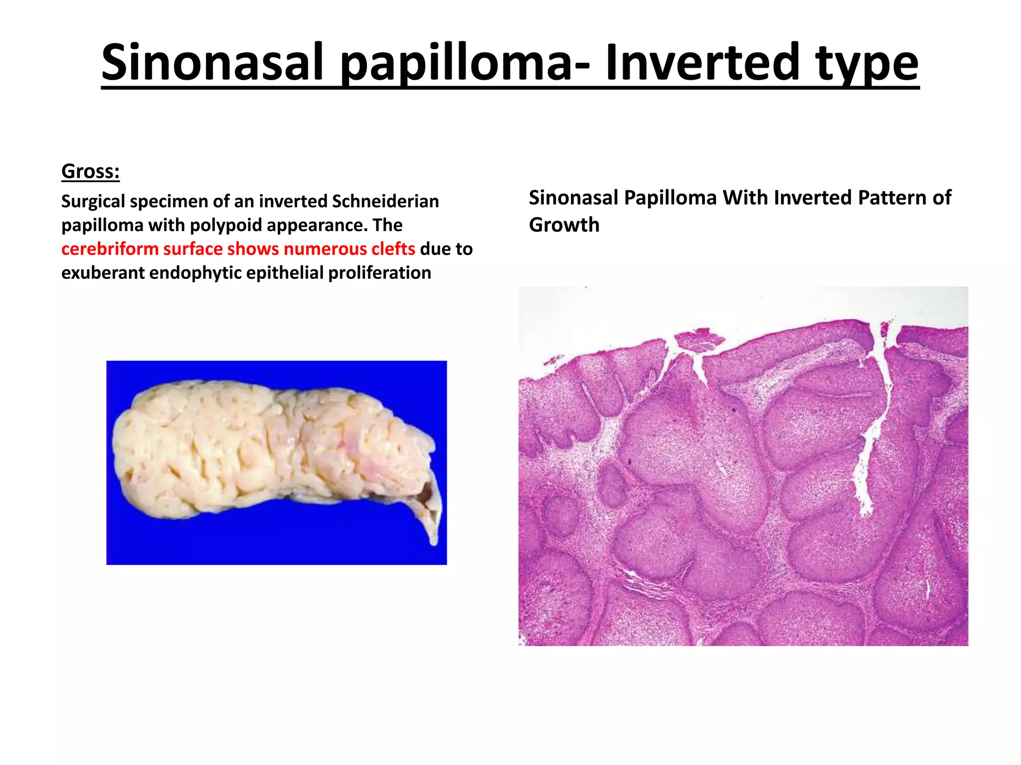 Sinonasal tract pathology(histopathology) | PPTX
