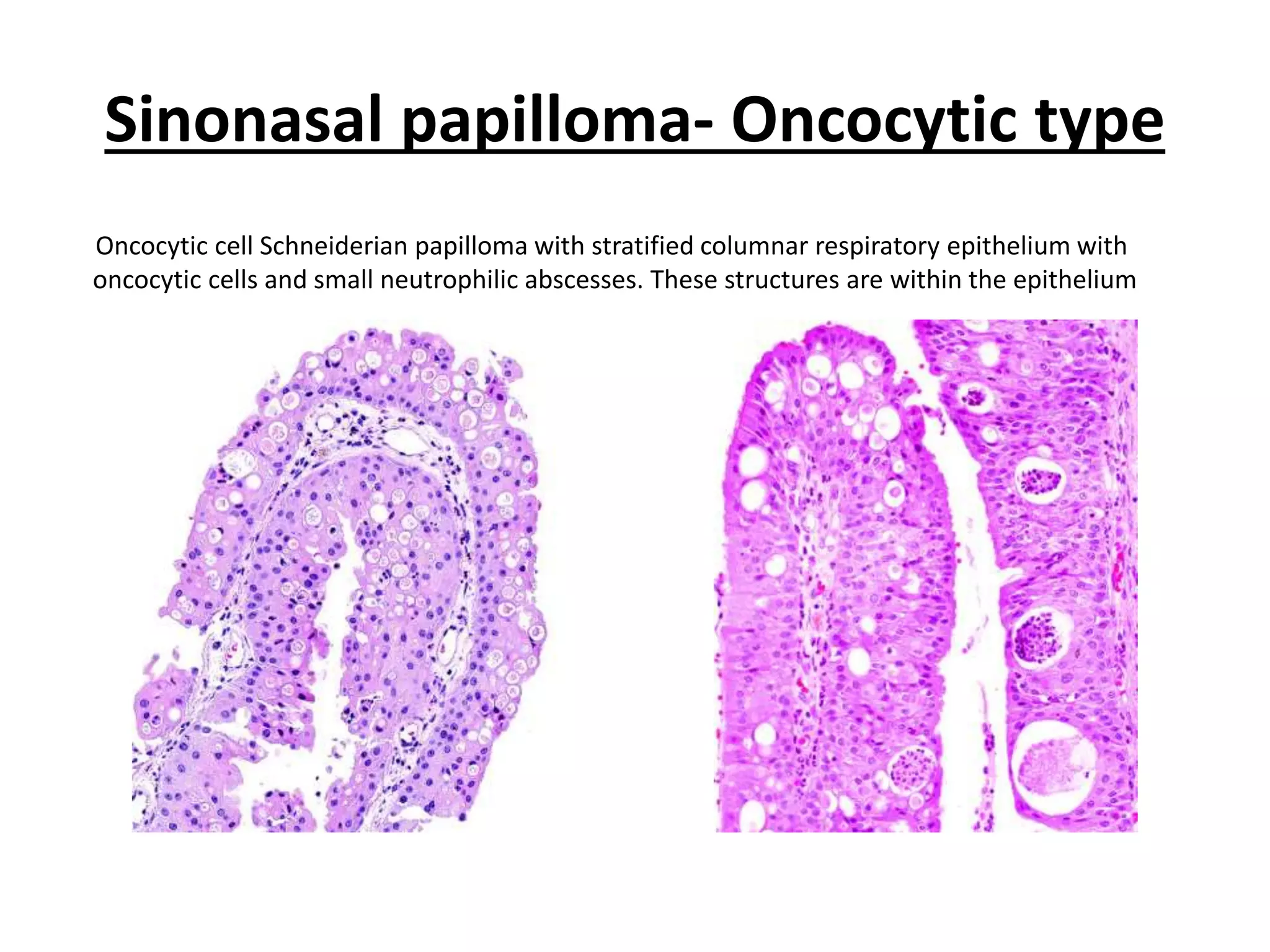 Sinonasal tract pathology(histopathology) | PPTX