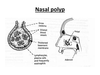 Sinonasal tract pathology(histopathology) | PPTX