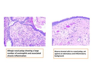 Sinonasal tract pathology(histopathology) | PPTX