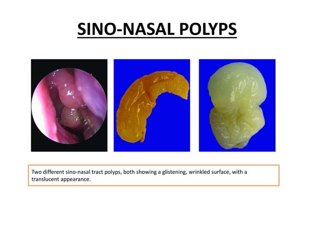 Sinonasal tract pathology(histopathology) | PPTX