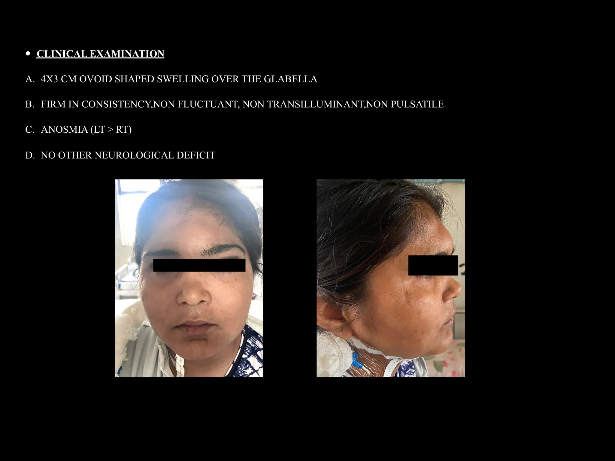 Rare case presentation of Sinonasal tumor | PDF