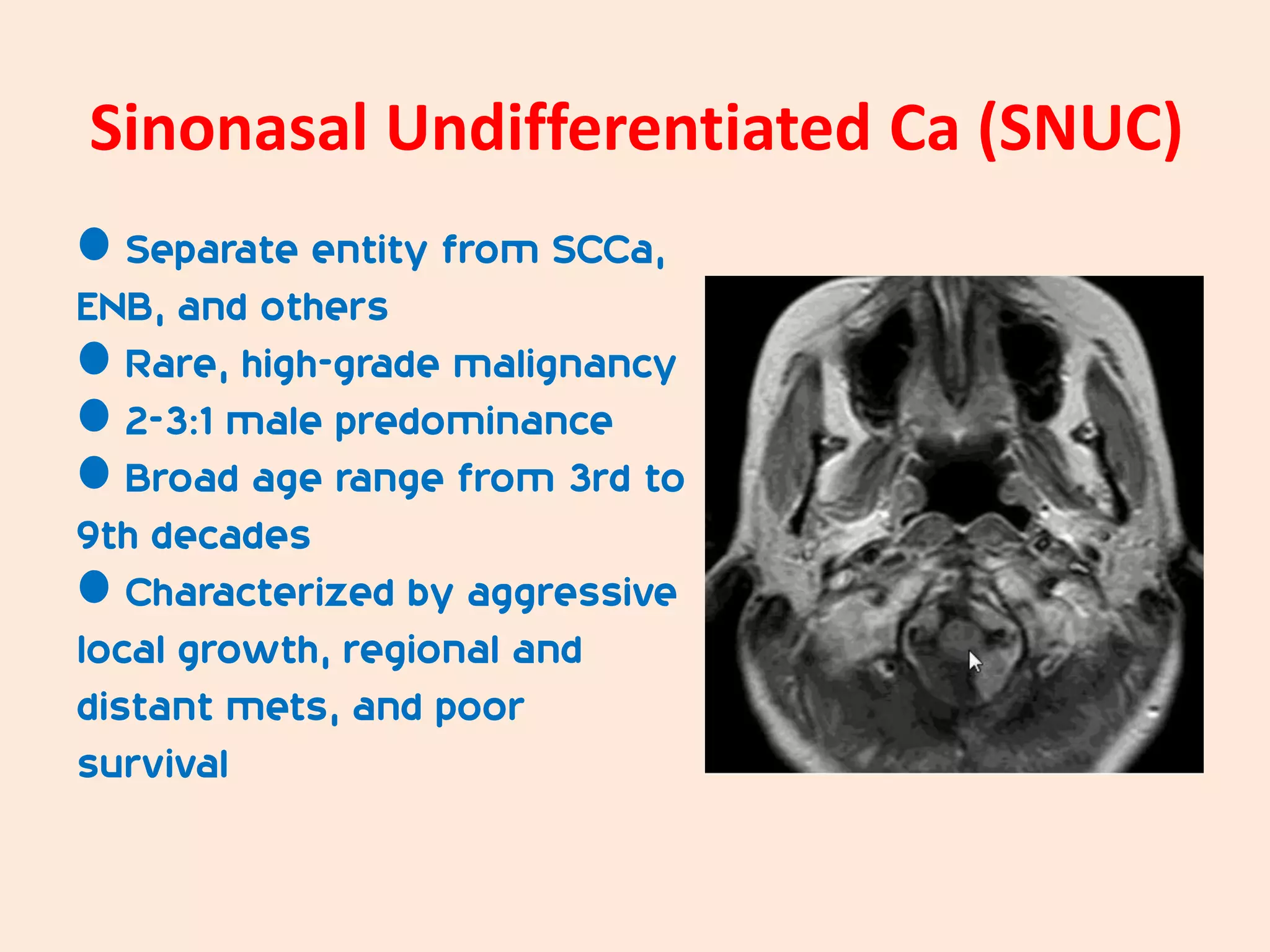 Tumours of nasal cavity & paranasal sinuses | PDF