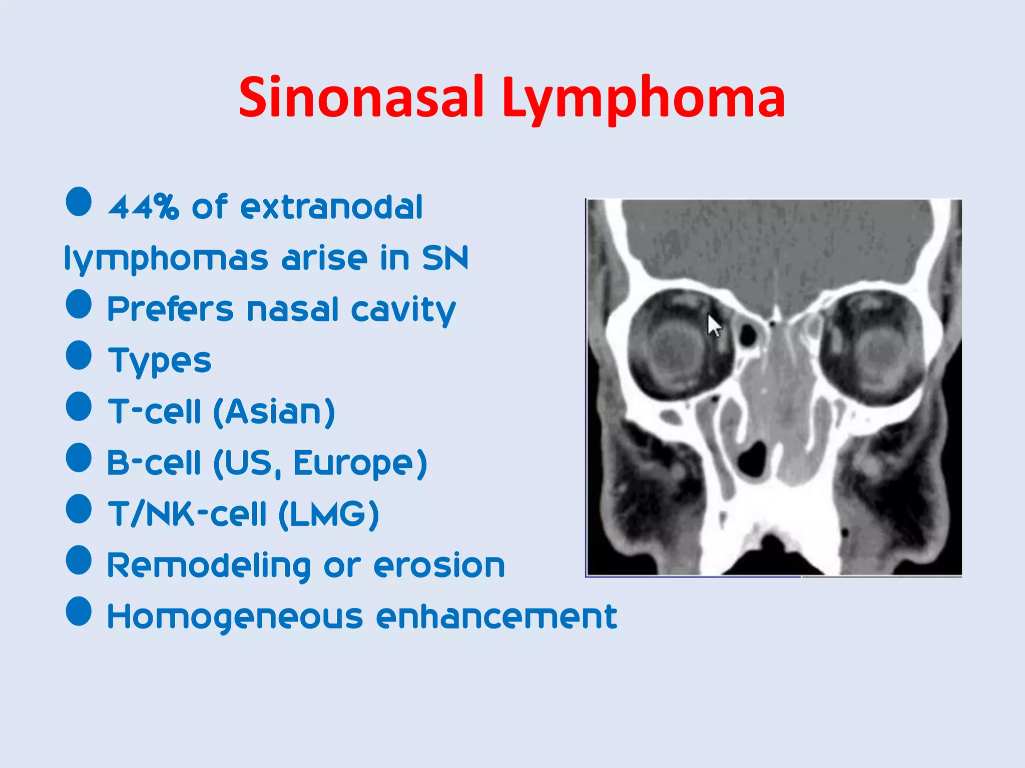 Tumours of nasal cavity & paranasal sinuses | PDF