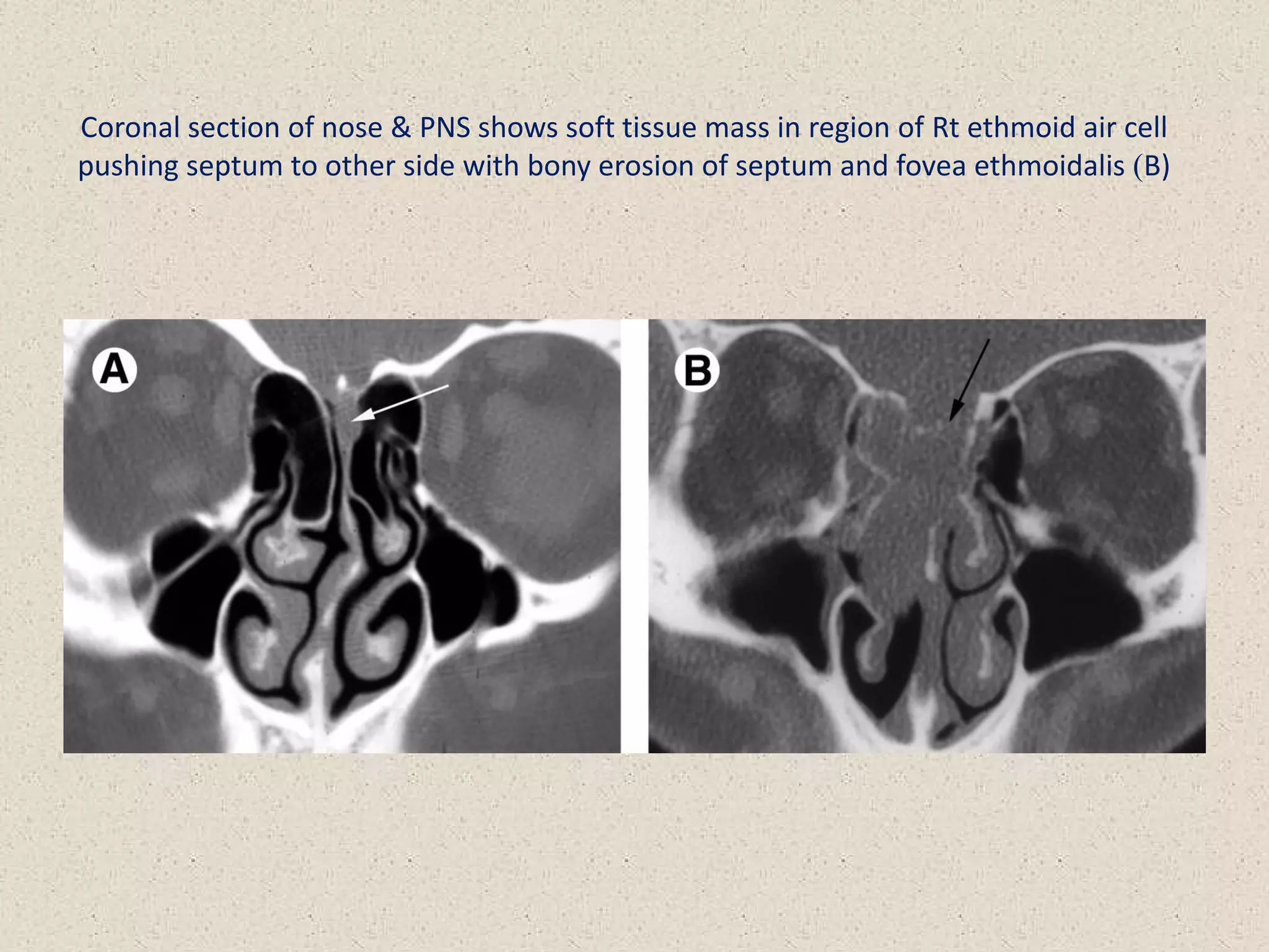 Tumours of nasal cavity & paranasal sinuses | PDF