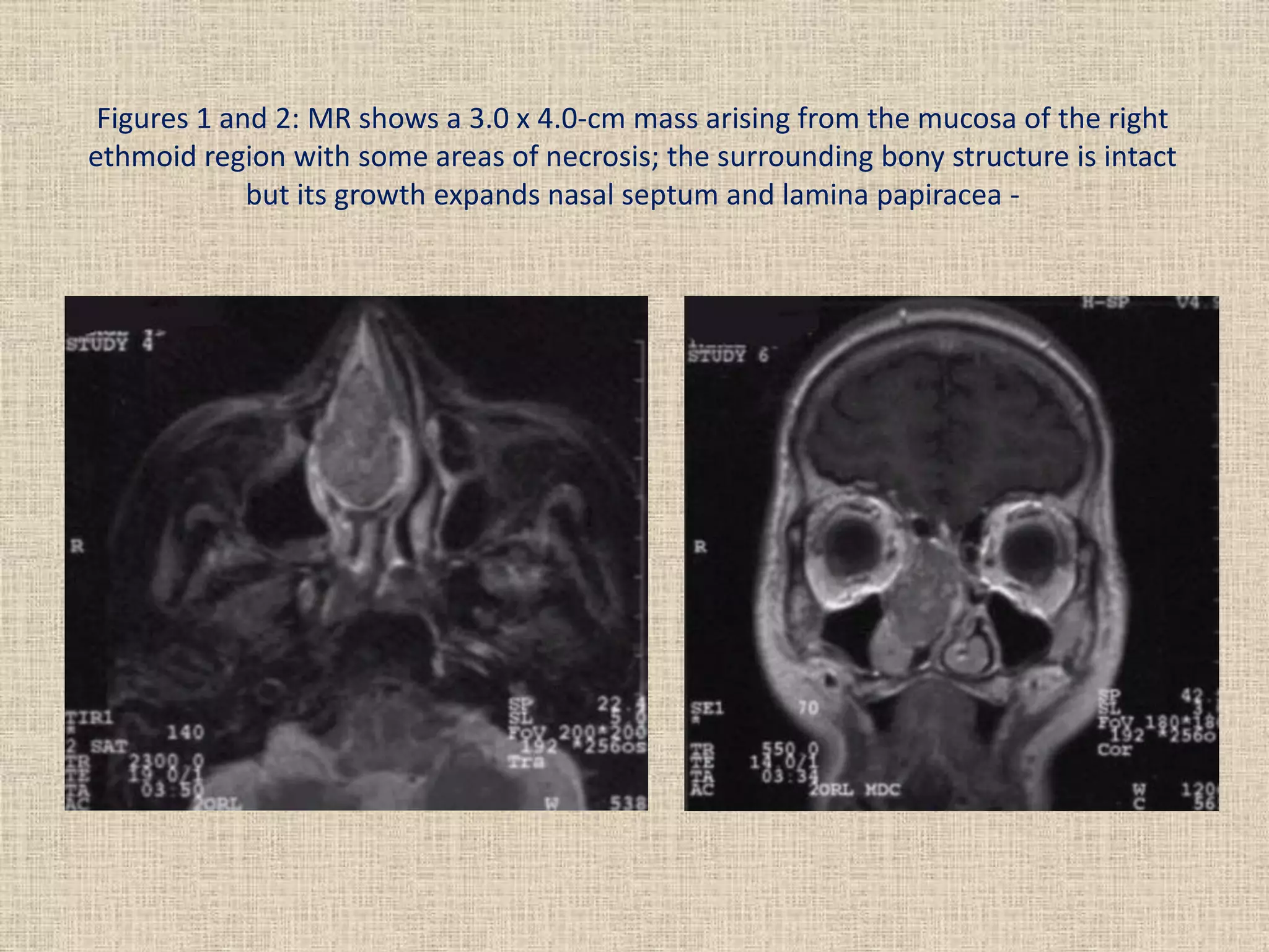 Tumours of nasal cavity & paranasal sinuses | PDF