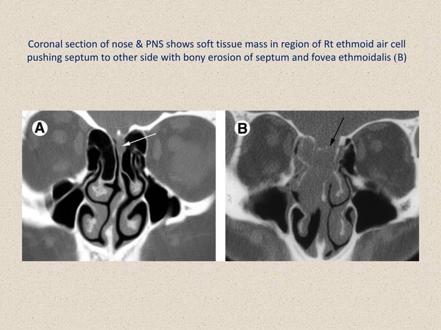 Tumours of nasal cavity & paranasal sinuses | PDF | Ear, Nose and ...