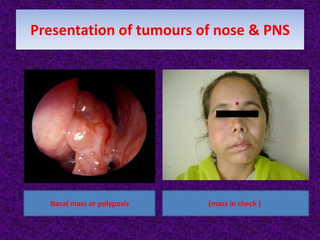 Tumours of nasal cavity & paranasal sinuses