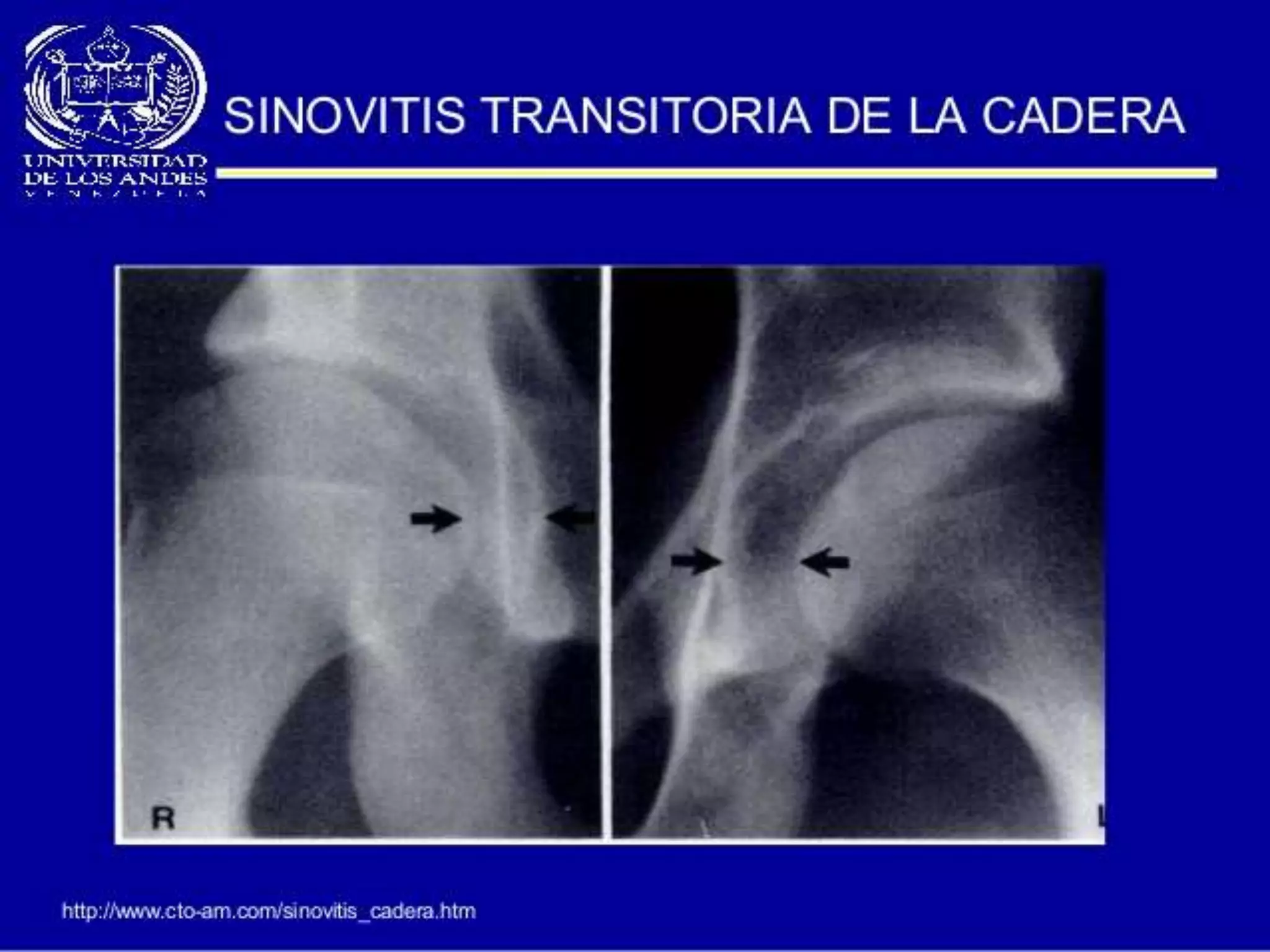 Sinovitis transitoria de la cadera | PPTX