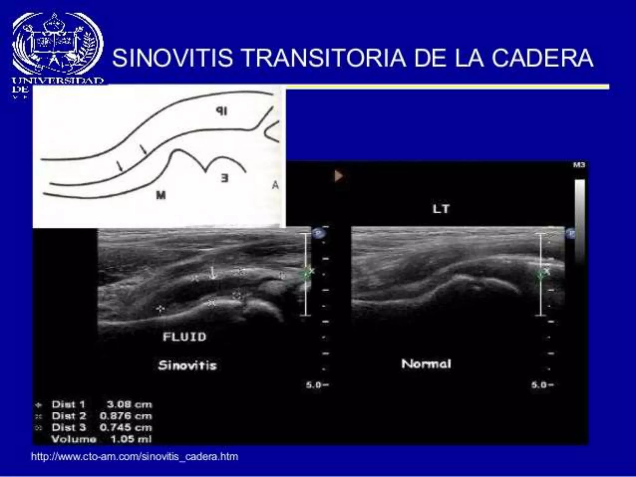 Sinovitis transitoria de la cadera | PPT