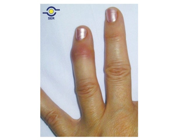 Dedo Hinchado Rojo Dolor Inflamacion Indice Entumecido