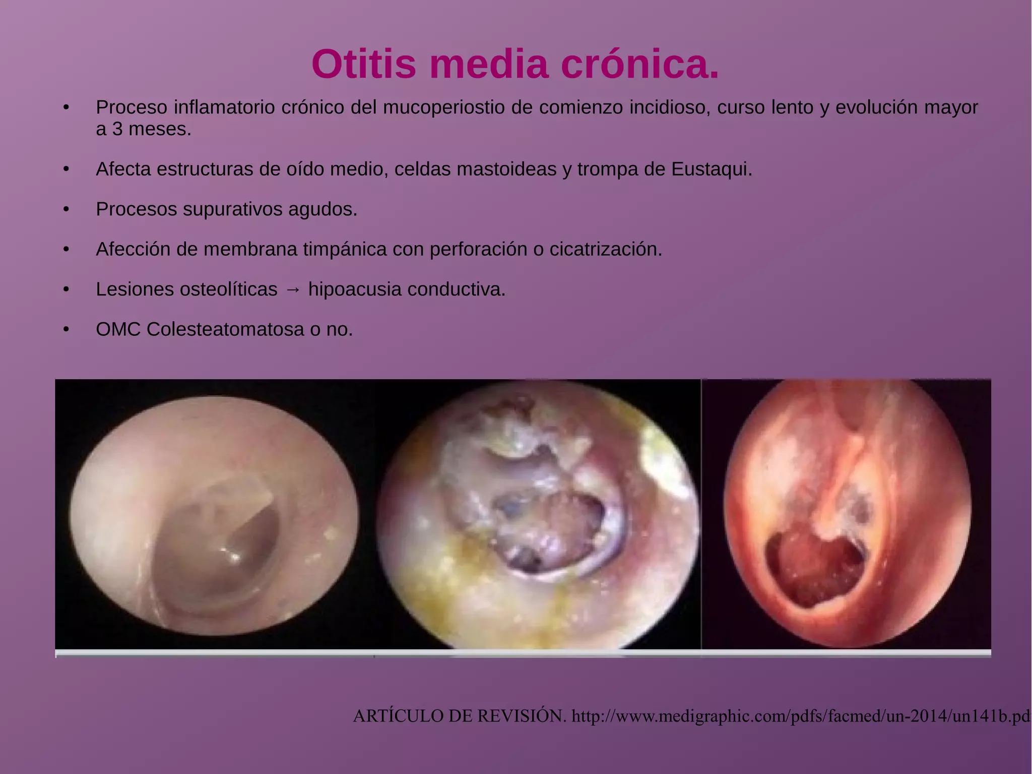 Otitis media bacteriana, AGUDA Y CRÓNICA. | ODP | Ear, Nose and Throat ...