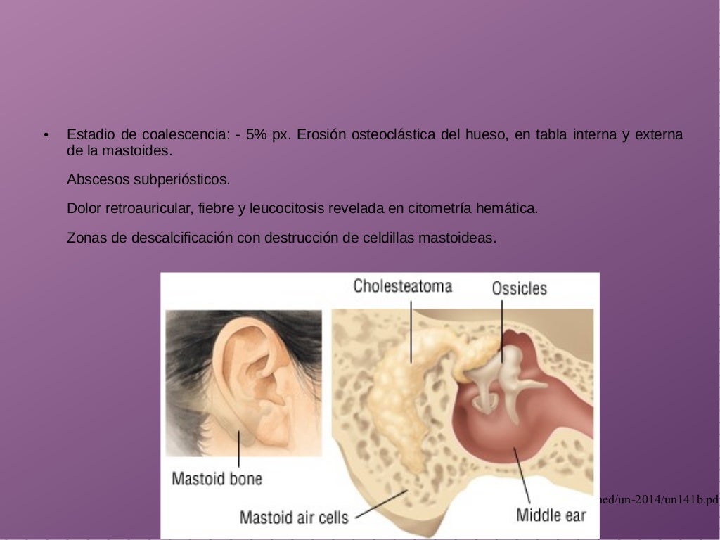 Otitis media bacteriana, AGUDA Y CRÓNICA.