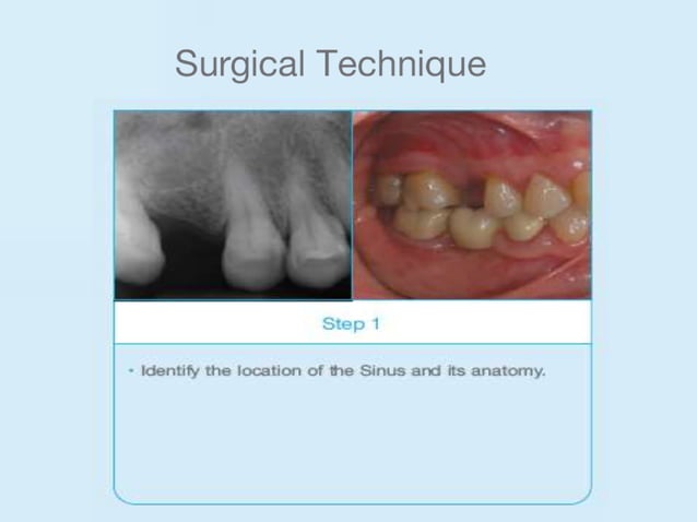 Sinus lift | PPT