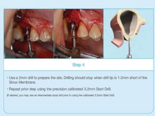 Sinus lift | PPT