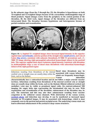 Radiological pathology of cerebral venous & dural sinus thrombosis | PDF