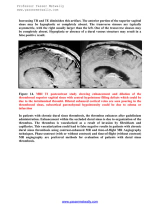 Radiological pathology of cerebral venous & dural sinus thrombosis | PDF