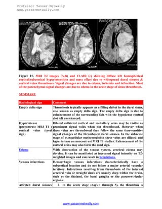 Radiological pathology of cerebral venous & dural sinus thrombosis | PDF