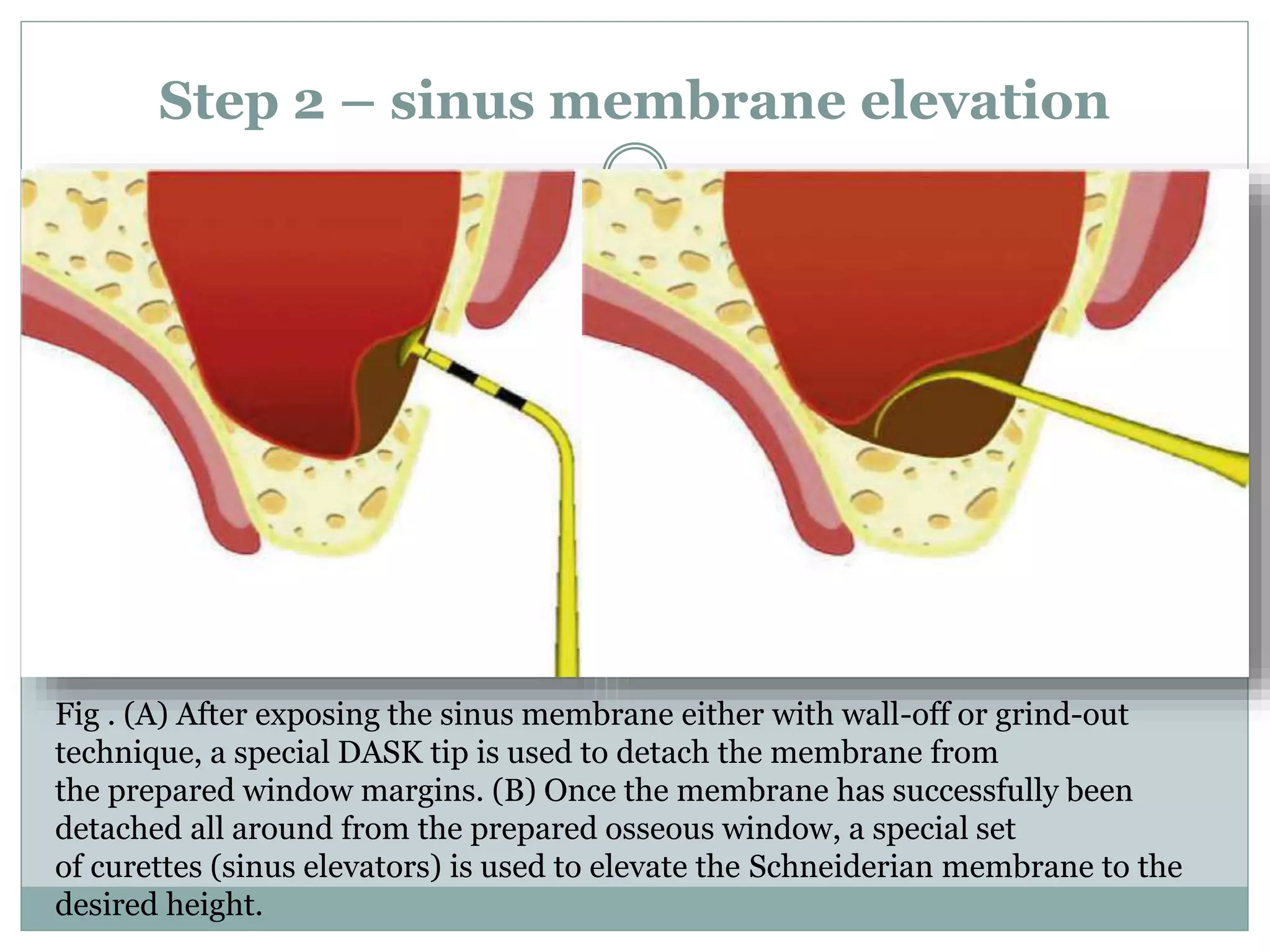 Sinus Lift with implant placement-surgical approach | PPTX
