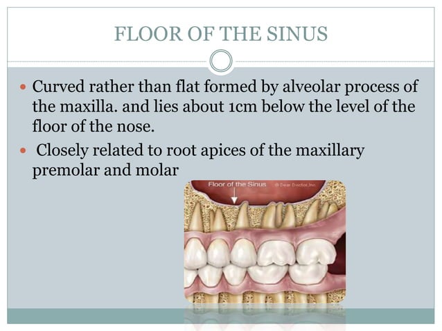 Sinus Lift with implant placement-surgical approach | PPTX
