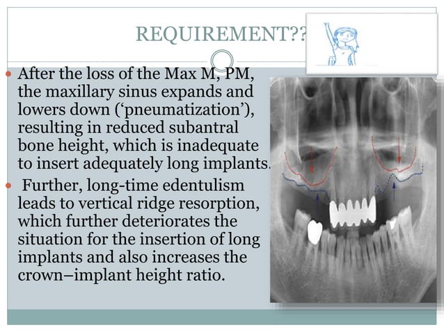 Sinus Lift with implant placement-surgical approach | PPTX