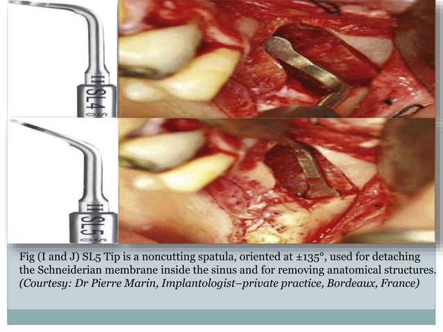 Sinus Lift with implant placement-surgical approach | PPTX