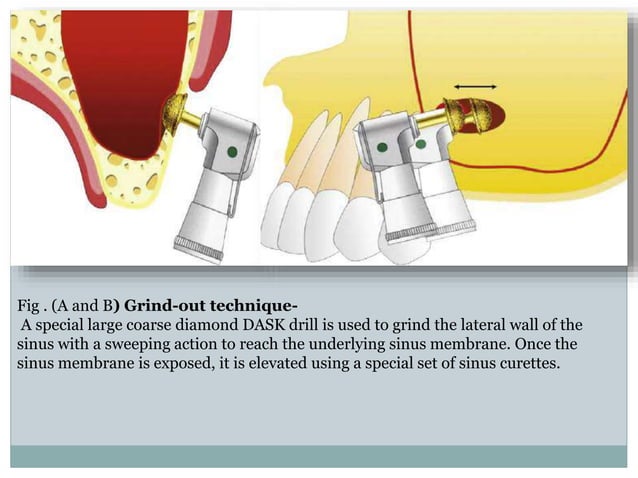 Sinus Lift with implant placement-surgical approach | PPTX