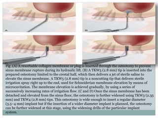 Sinus Lift with implant placement-surgical approach | PPTX