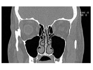 Sinus-Imaging.ppt