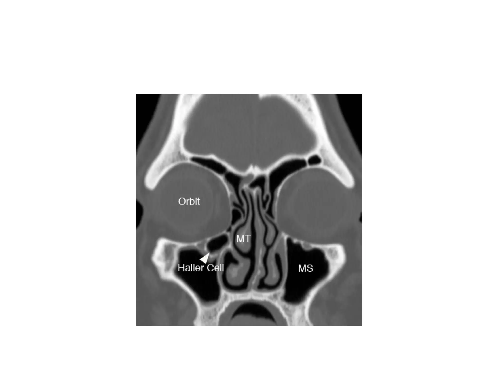 Sinus Anatomy And Variants Ppt