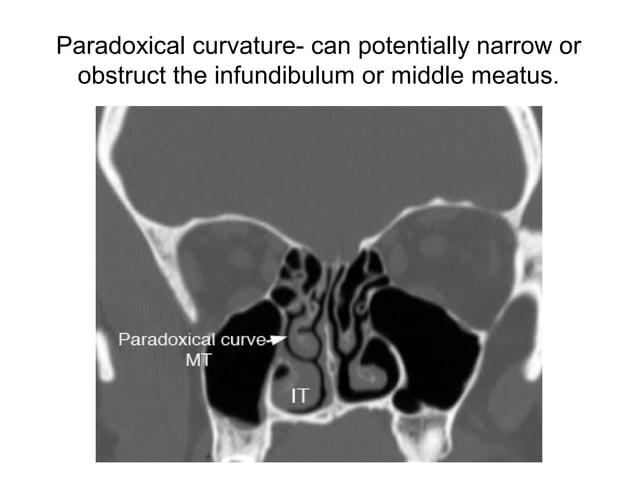Sinus anatomy and variants | PPT