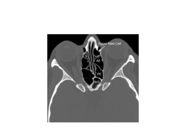 Sinus anatomy and variants | PPT
