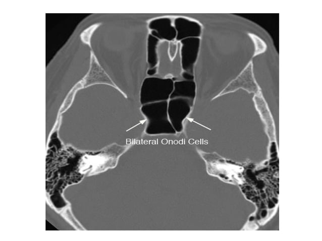 Sinus anatomy and variants | PPT