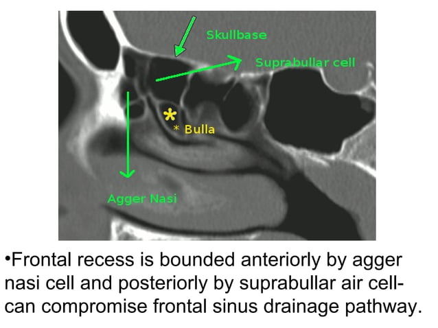 Sinus anatomy and variants | PPT