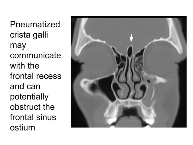 Sinus anatomy and variants | PPT