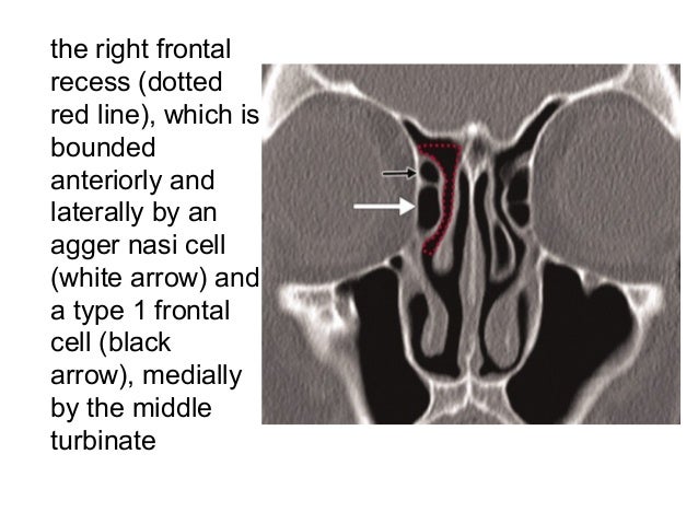 Sinus anatomy and variants