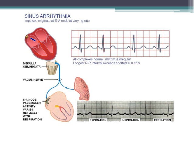 Sinus and atrial arrhythmias | PPTX