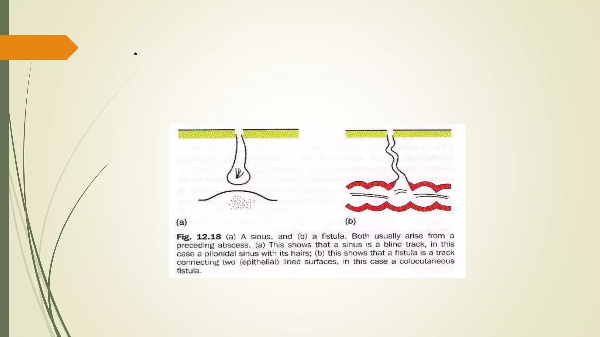 Sinus and fistula | PPTX