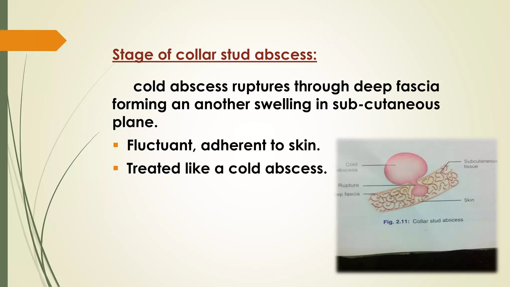 Sinus and fistula | PPTX