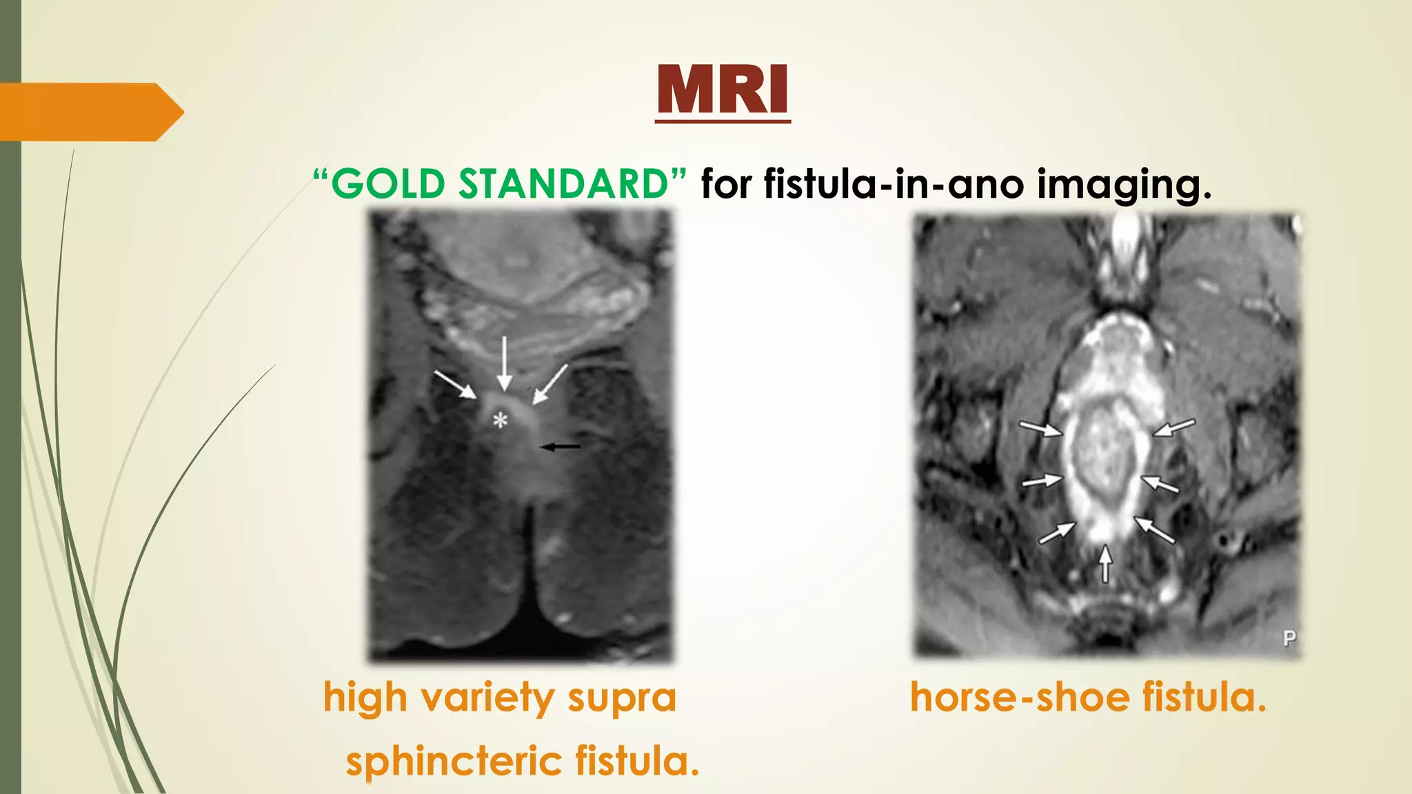 Sinus and fistula | PPTX
