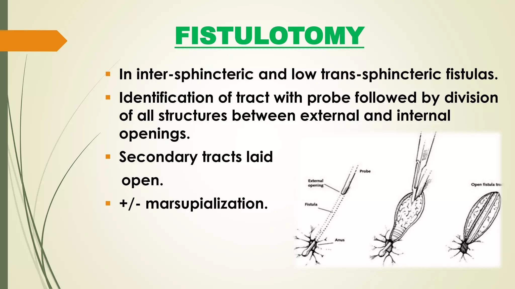 Sinus and fistula | PPTX