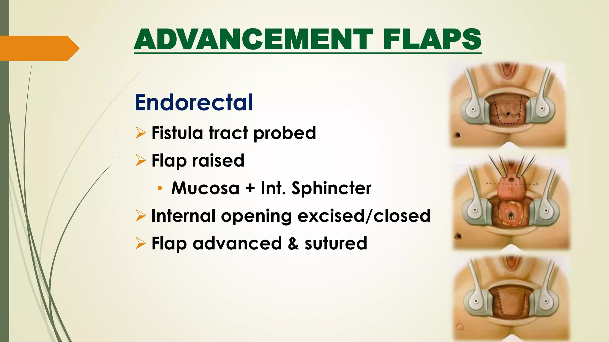Sinus and fistula | PPTX
