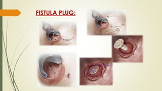 Sinus and fistula | PPTX