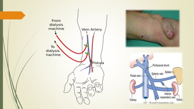 Sinus and fistula | PPTX | Ear, Nose and Throat Conditions | Diseases ...